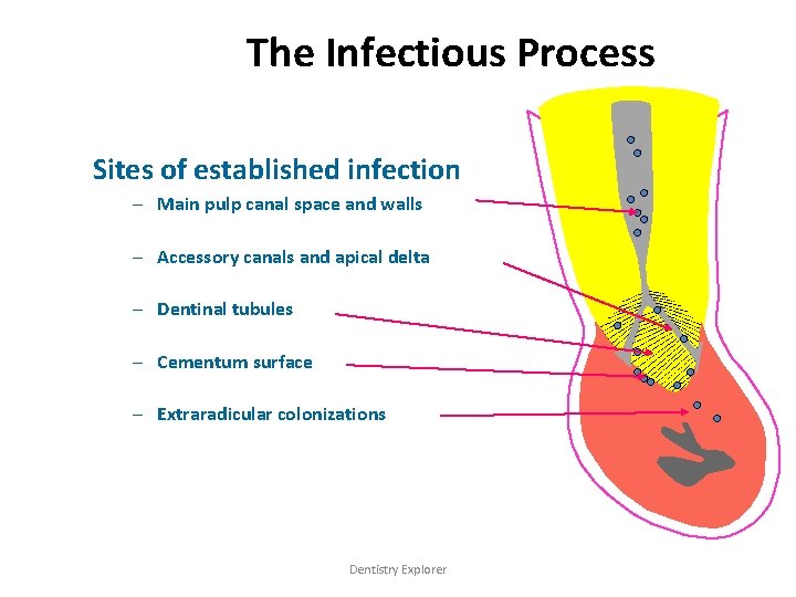 Diseases of the Periradicular Tissue DEPARTMENT OF ORAL