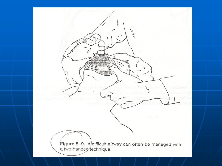 RESUSCITAREA CARDIORESPIRATORIE 1950 Peter Safar redescopera respiratia ...