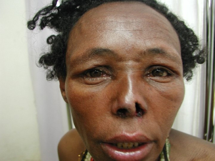 CUTANEOUS TUBERCULOSIS Cutaneous TB Relatively uncommon form of