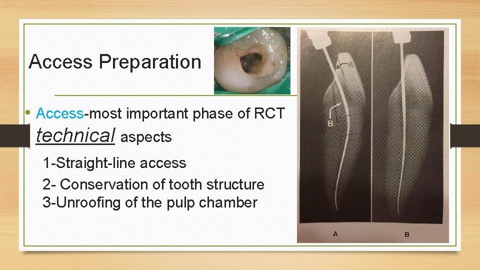 Endodontics AKA Root Canal Therapy RCT 1 Describe