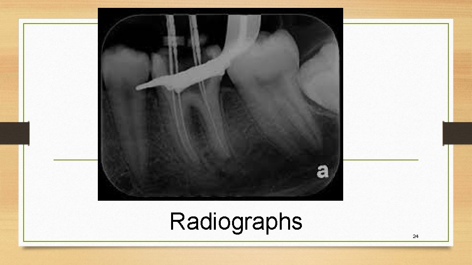 Endodontics AKA Root Canal Therapy RCT 1 Describe