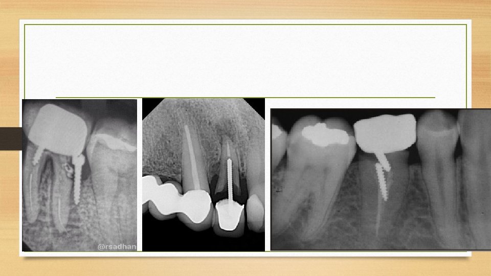 Endodontics AKA Root Canal Therapy RCT 1 Describe