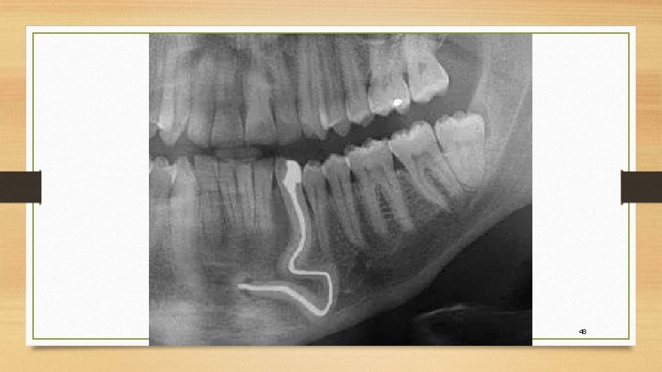 Endodontics AKA Root Canal Therapy RCT 1 Describe