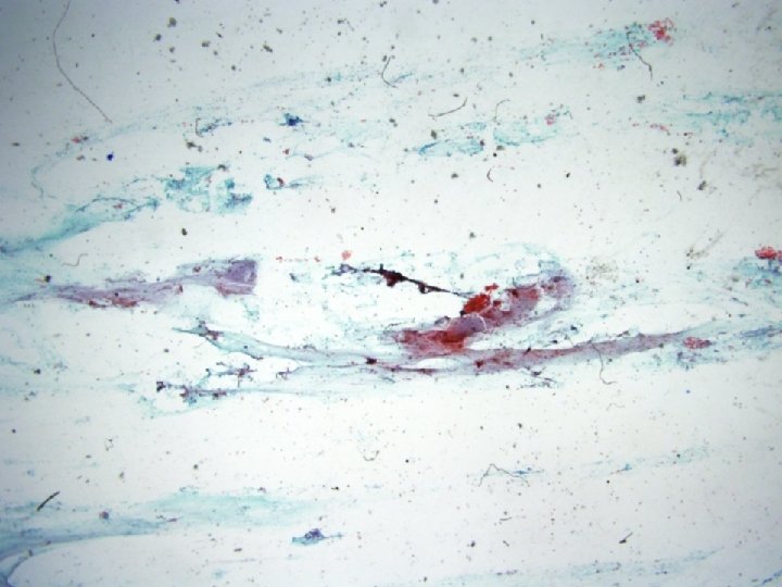 Cytologic features Background Necrotic tumor diathesis Cellularity Moderate