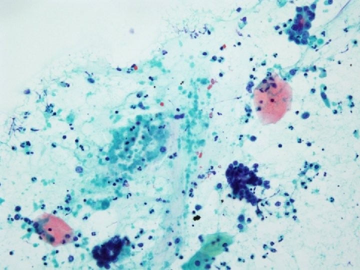 Cytologic features Background Necrotic tumor diathesis Cellularity Moderate