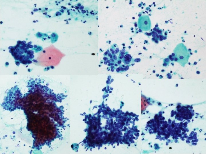 Cytologic features Background Necrotic tumor diathesis Cellularity Moderate
