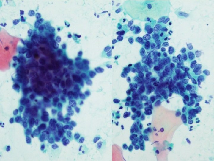 Cytologic features Background Necrotic tumor diathesis Cellularity Moderate