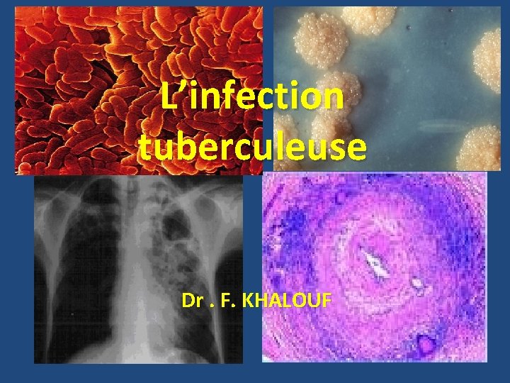 Linfection tuberculeuse Dr F KHALOUF La tuberculose maladie