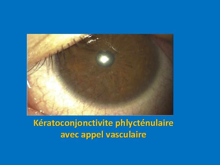 Linfection tuberculeuse Dr F KHALOUF La tuberculose maladie