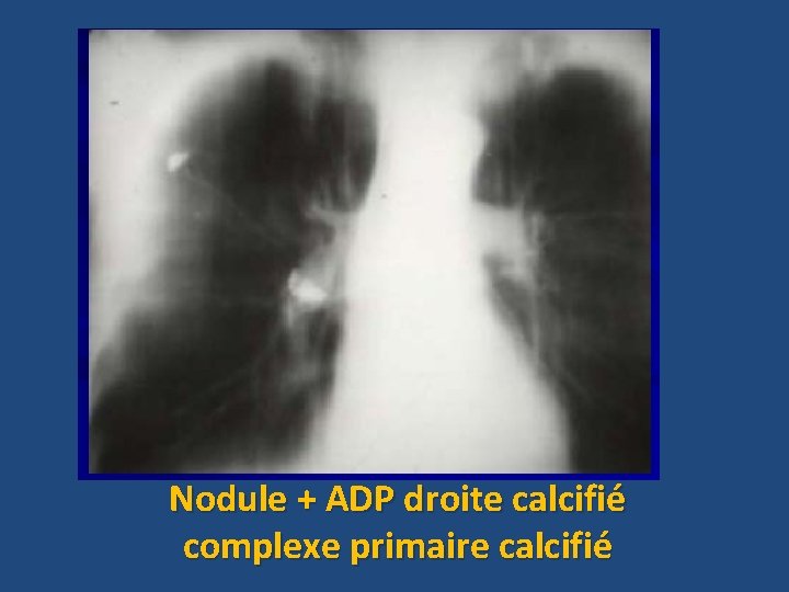 Linfection tuberculeuse Dr F KHALOUF La tuberculose maladie