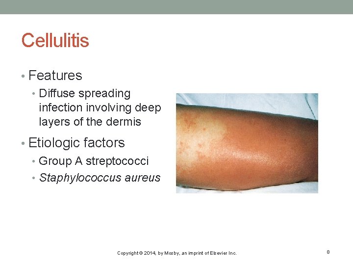 CHAPTER 76 Skin Soft Tissue and Wound Infections