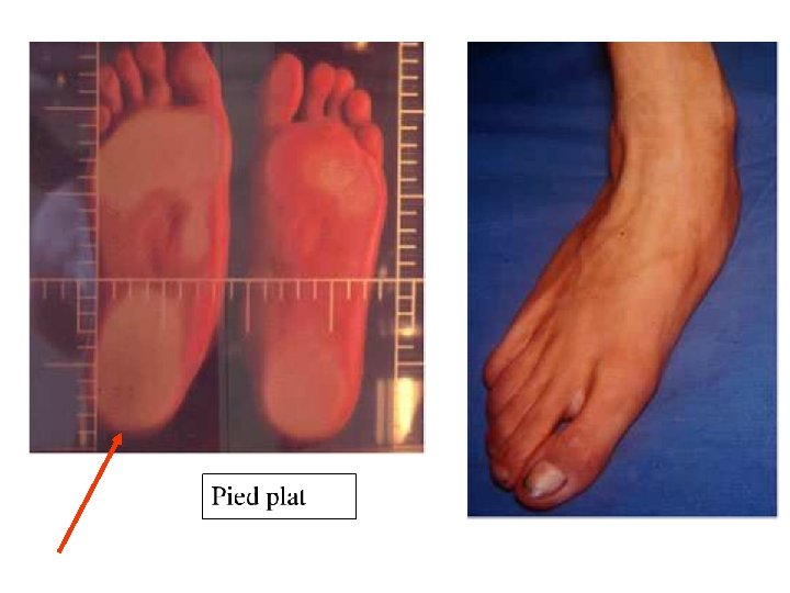 SEMIOLOGIE DU PIED ET CHEVILLE Emilie Acquacalda Rhumatologie