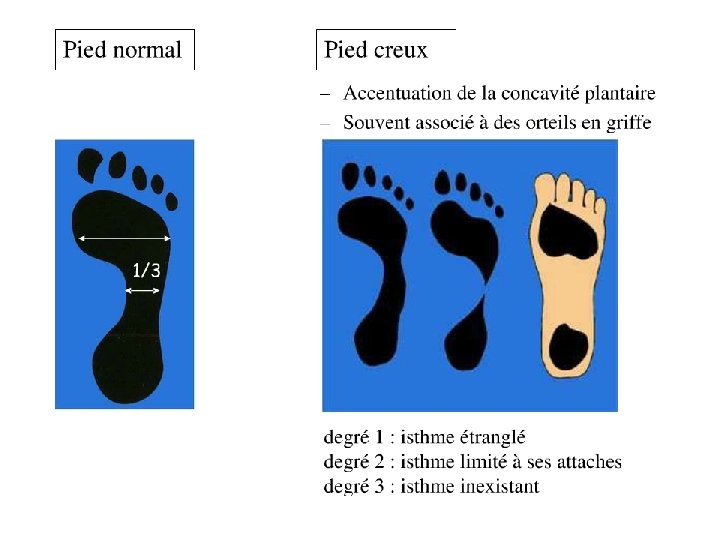 SEMIOLOGIE DU PIED ET CHEVILLE Emilie Acquacalda Rhumatologie
