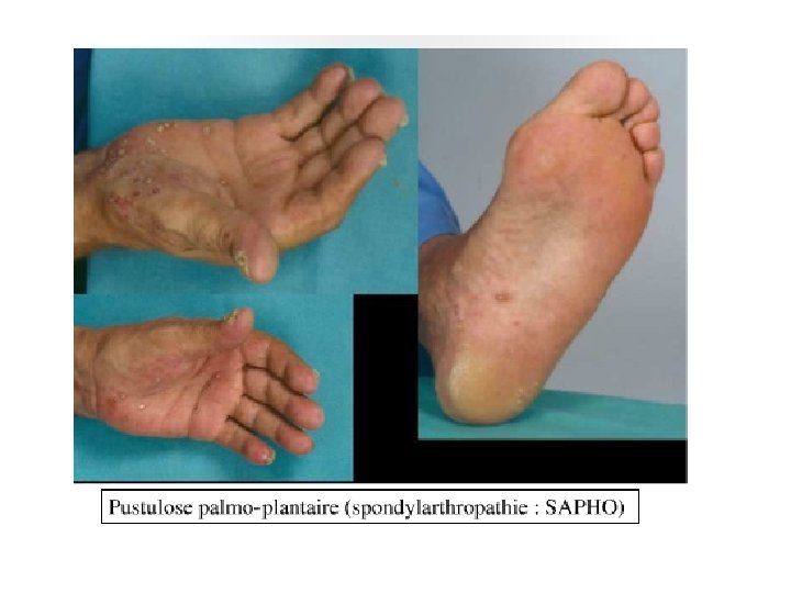 SEMIOLOGIE DU PIED ET CHEVILLE Emilie Acquacalda Rhumatologie