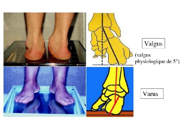 SEMIOLOGIE DU PIED ET CHEVILLE Emilie Acquacalda Rhumatologie