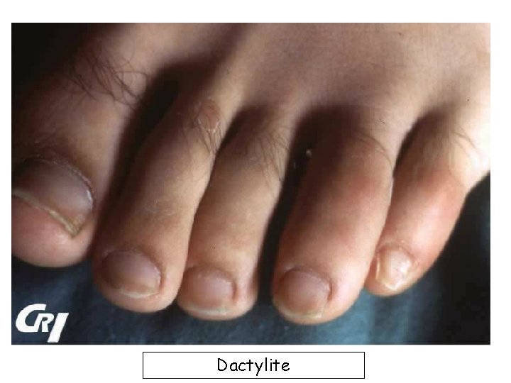 SEMIOLOGIE DU PIED ET CHEVILLE Emilie Acquacalda Rhumatologie