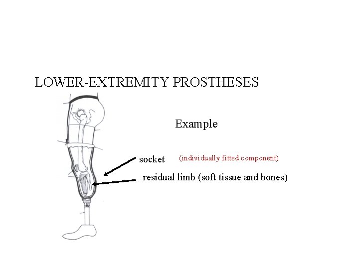 Lecture 10 Dimitar Stefanov LOWEREXTREMITY PROSTHESES Example socket