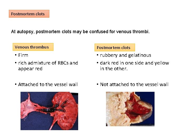 Thromboembolism Pathology Department KSU Riyadh 2015 Objectives Understand