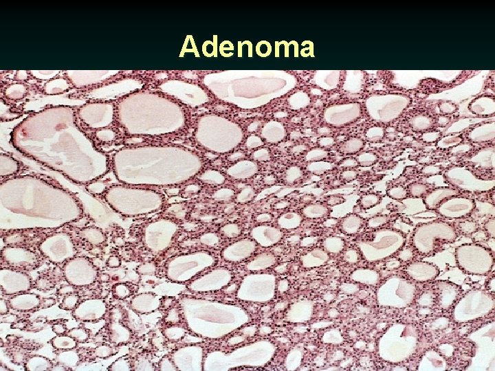 Neoplasia Nomenclature Benign oma adenoma fibroma Malignant carcinoma