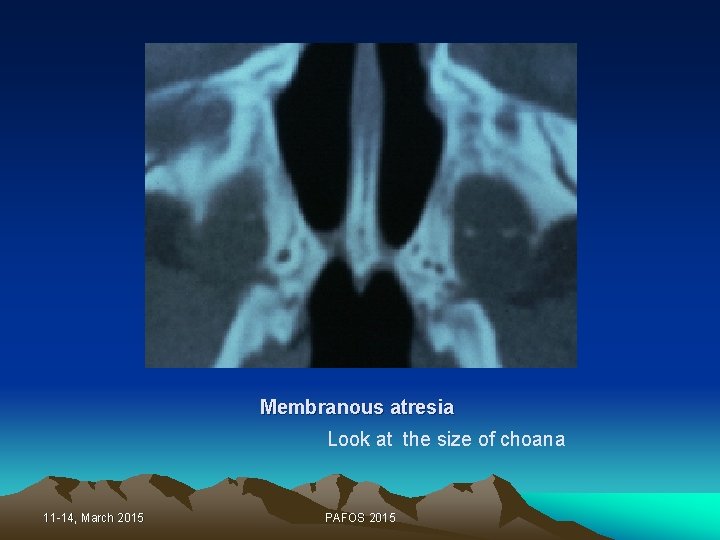 Endoscopic Repair of Bilateral Congenital Choanal Atresia over