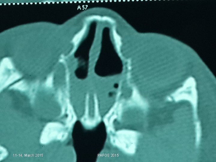 Endoscopic Repair of Bilateral Congenital Choanal Atresia over