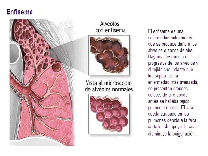 Enfisema Pulmonar Professor Vernica Pantoja Lic MSP Kinesiologia