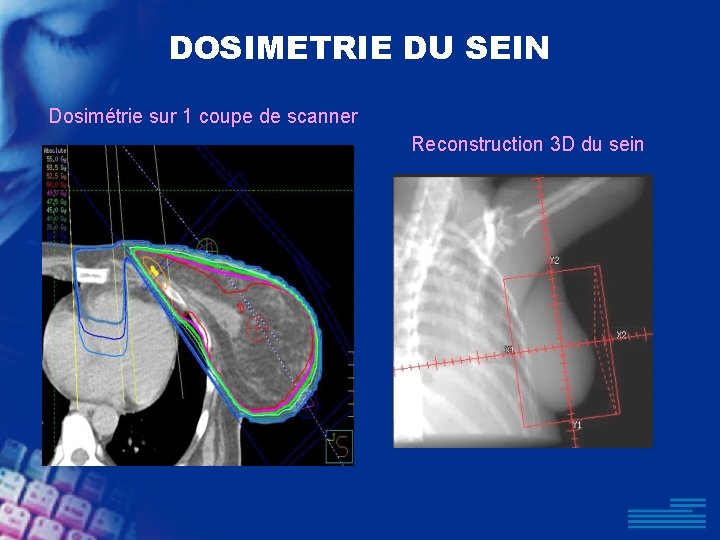 PRINCIPE DE LA RADIOTHERAPIE ET DE LA CURIETHERAPIE