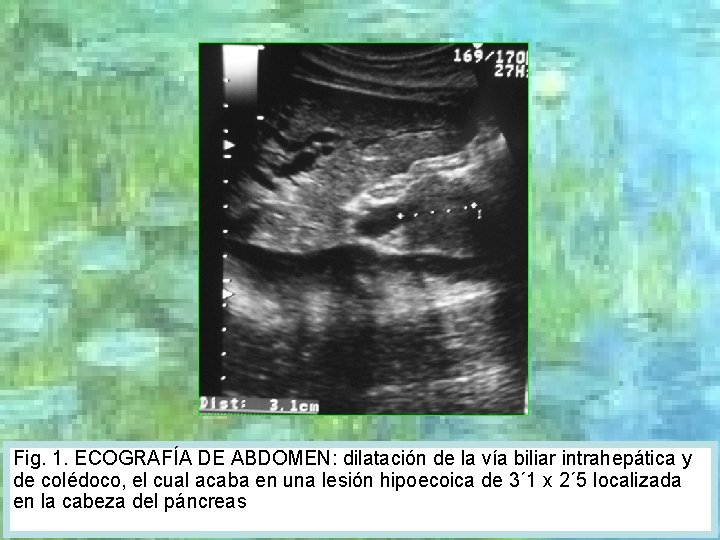 Fig 0 Esquema de las estenosis del conducto
