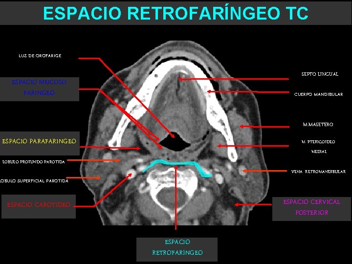 ESPACIO RETROFARINGEO DEFINICIN Espacio de la lnea media