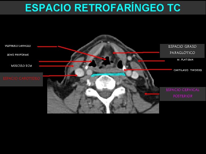 ESPACIO RETROFARINGEO DEFINICIN Espacio de la lnea media