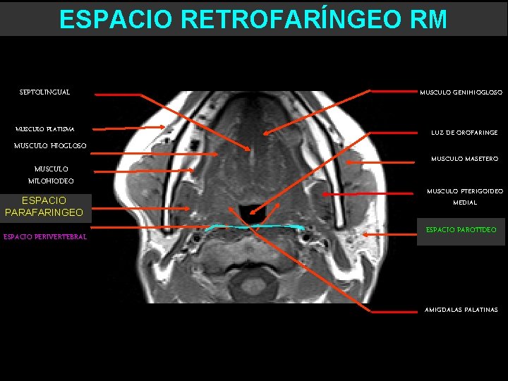 ESPACIO RETROFARINGEO DEFINICIN Espacio de la lnea media