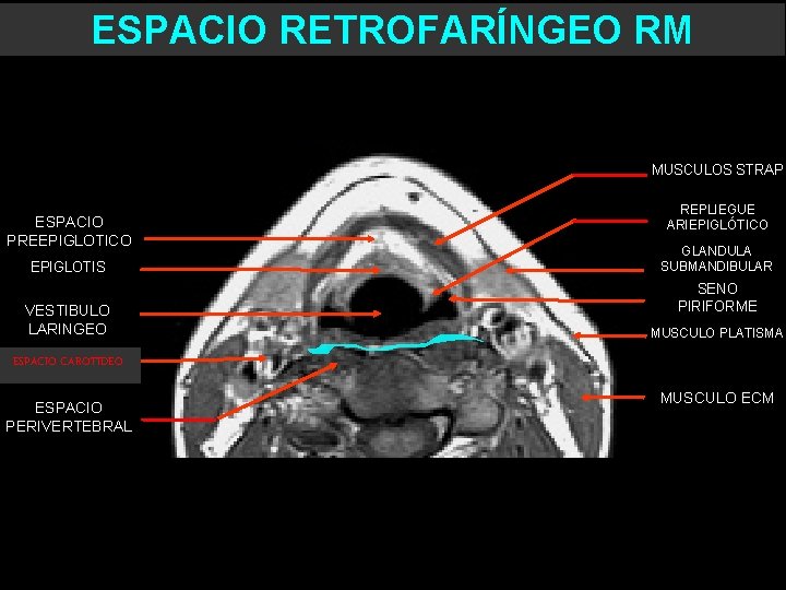 ESPACIO RETROFARINGEO DEFINICIN Espacio de la lnea media
