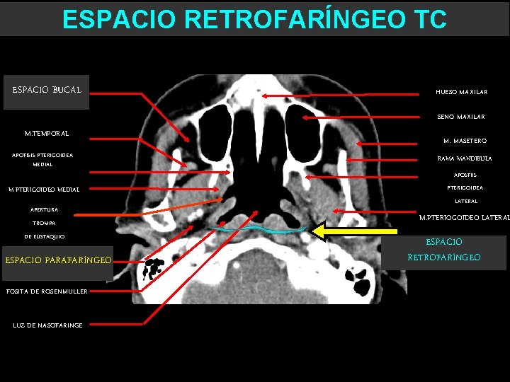 ESPACIO RETROFARINGEO DEFINICIN Espacio de la lnea media