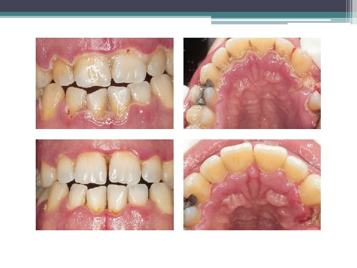 Acute gingival infections Logien Al Ghazal 27102015 Acute