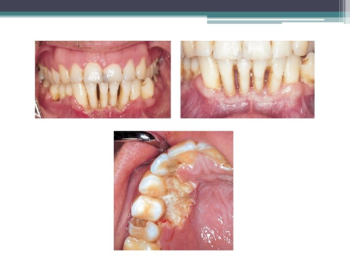 Acute gingival infections Logien Al Ghazal 27102015 Acute