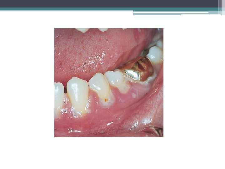Acute gingival infections Logien Al Ghazal 27102015 Acute