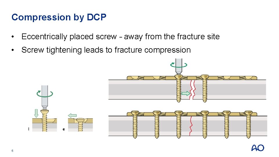 The use of plates in fracture fixation AO