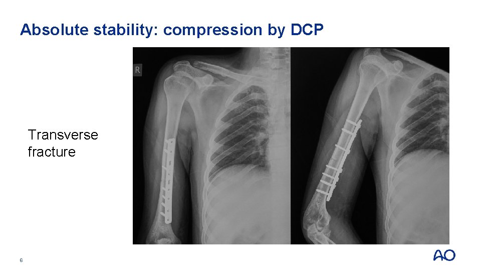 The use of plates in fracture fixation AO