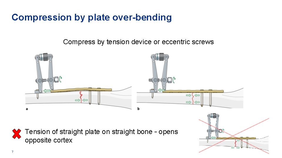 The use of plates in fracture fixation AO