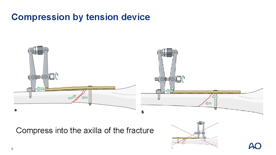 The use of plates in fracture fixation AO