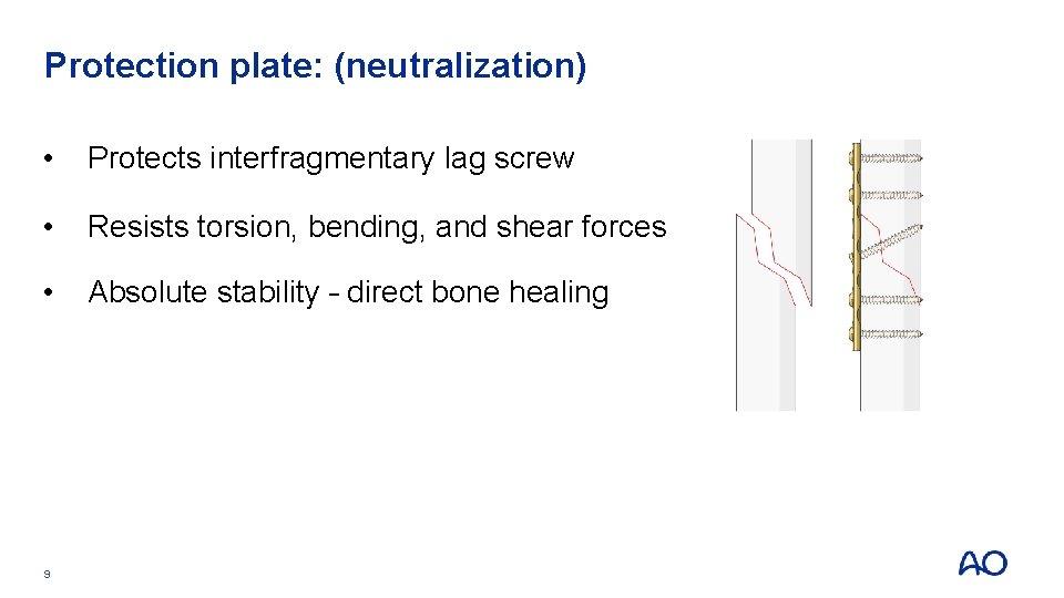 The use of plates in fracture fixation AO
