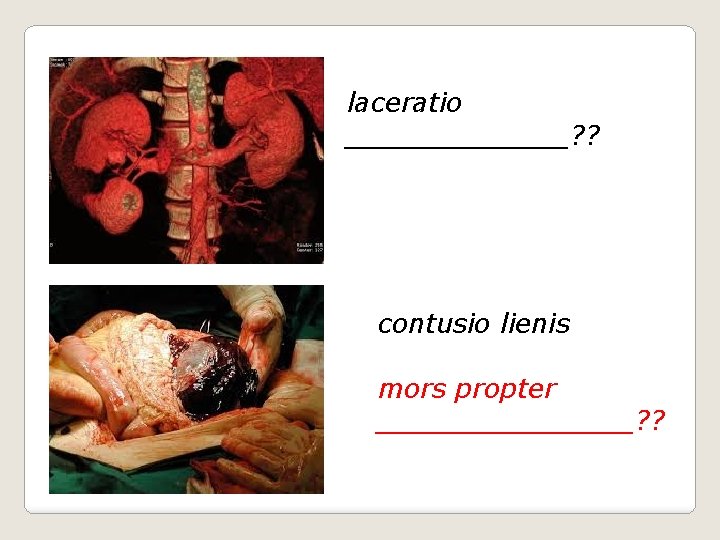 INJURIES IN CLINICAL TERMINOLOGY Tear wound a wound