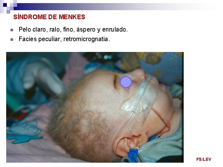 SNDROME DE MENKES PRINCIPALES CARACTERSTICAS MENKES DISEASE MAIN