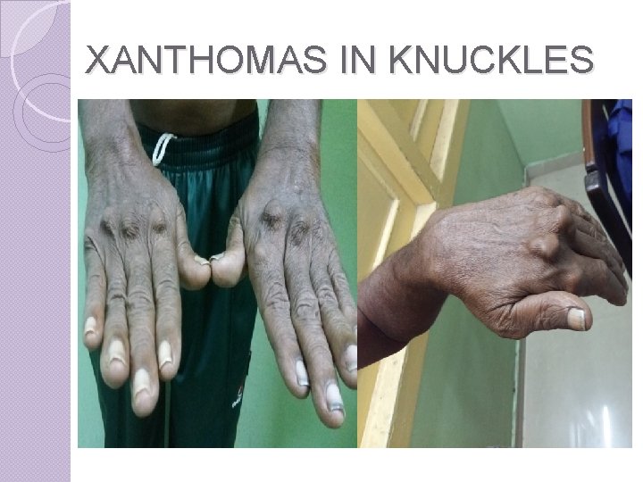 AN INTERSTING CASE OF HYPERLIPIDEMIA SECOND MEDICAL UNIT