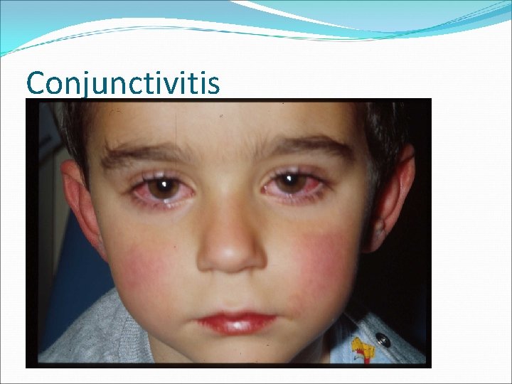 Keloid NEUROSENSORY SYSTEM ANATOMY PHYSIOLOGY OF EYES EXTERNAL