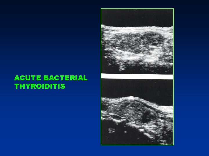 THYROIDITIS Inflammatory diseases of the thyroid gland with
