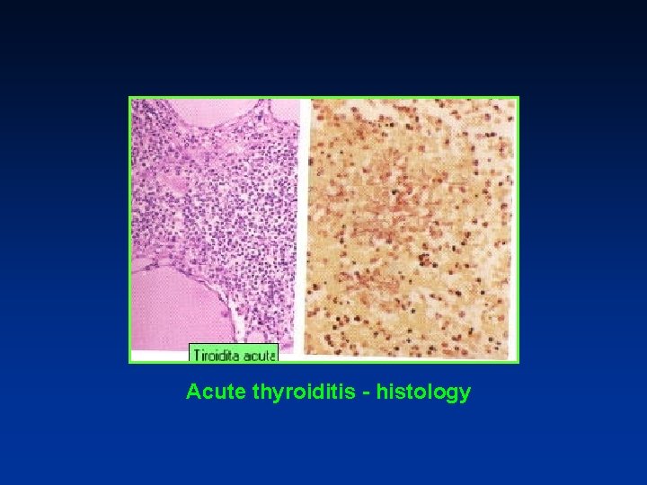 THYROIDITIS Inflammatory diseases of the thyroid gland with
