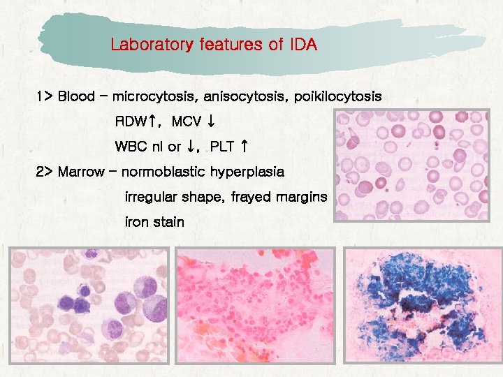 1 Anemia 2 Iron metabolism 3 Iron deficiency
