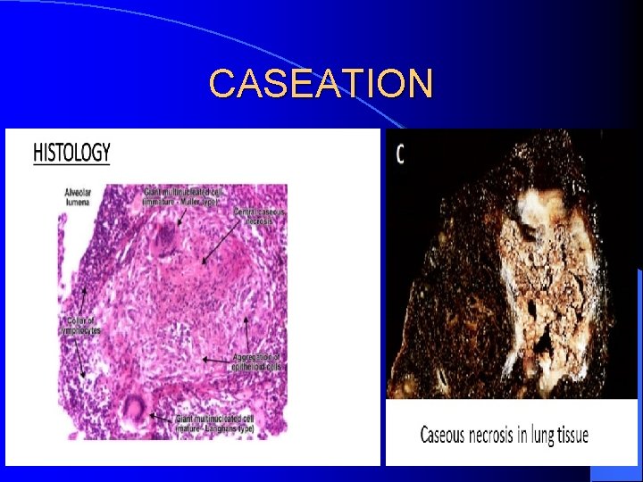Mycobacteria Tuberculosis PROF HANAN HABIB DR KHALIFA BINKHAMIS