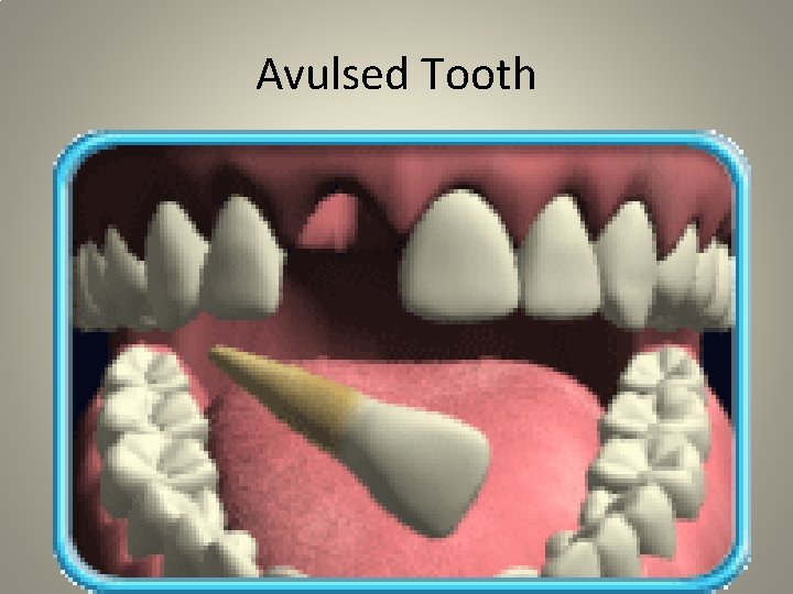Facial Injuries Sports Med II Mandible Fracture Cause
